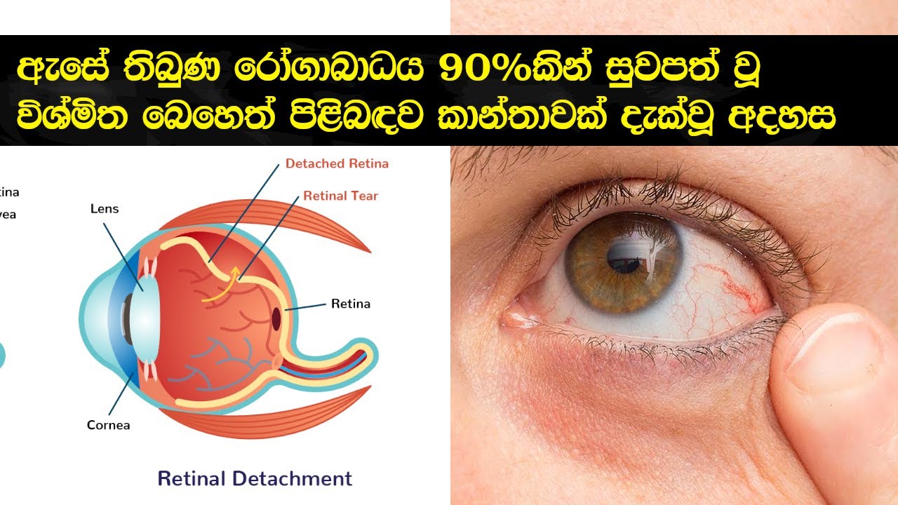 Incurable eye retina detachment cures in three weeks - Discussion with ...