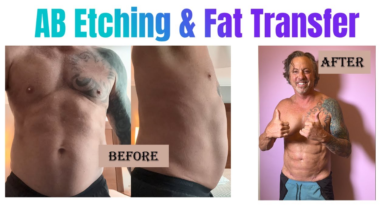 53-Year-Old Transforms His Abs with Dr. Curves | Ab Etching + Fat ...