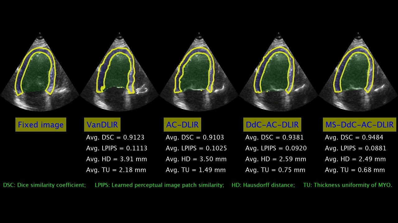 Temporal Echo Image Registration for Adult A4C view - YouTube