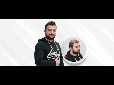 Trakya Hair Lüleburgaz Protez Saç Uygulaması