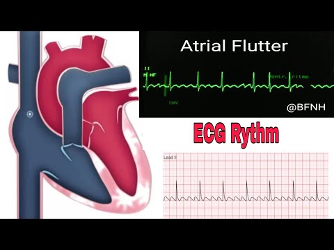 Atrial flutter // EKG(  ECG) Interpretation Atrial Flutter क्या होता है  ECG RYTHM #bfnh