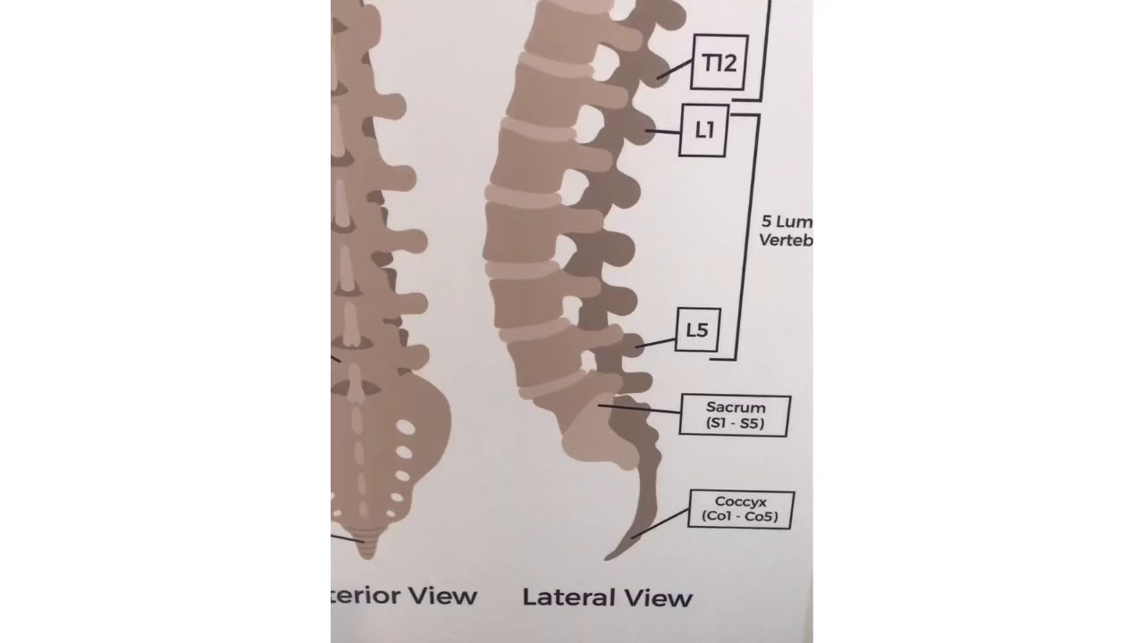 Listhesis - slippage of a vertebra - YouTube