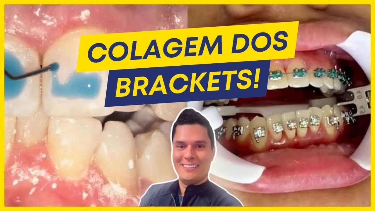 Colagem de Brackets: Técnicas e Princípios Essenciais. - YouTube