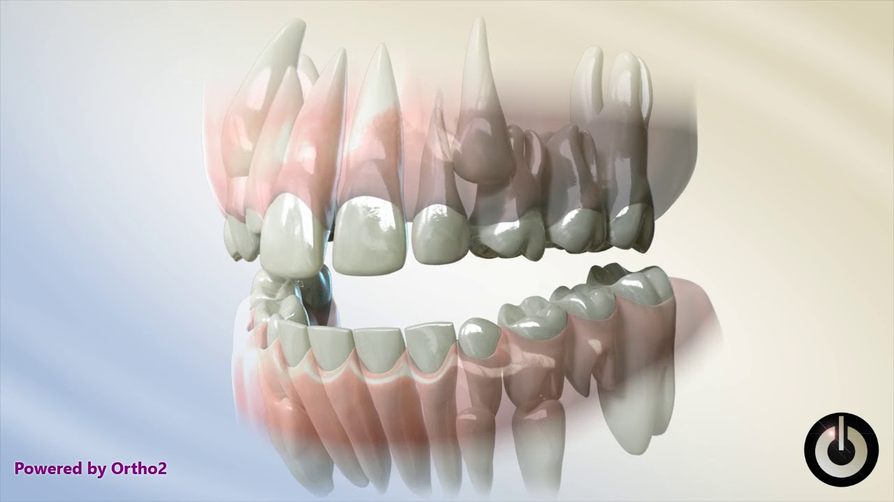 Midline Shift Due to Blocked Out Teeth Upper - YouTube