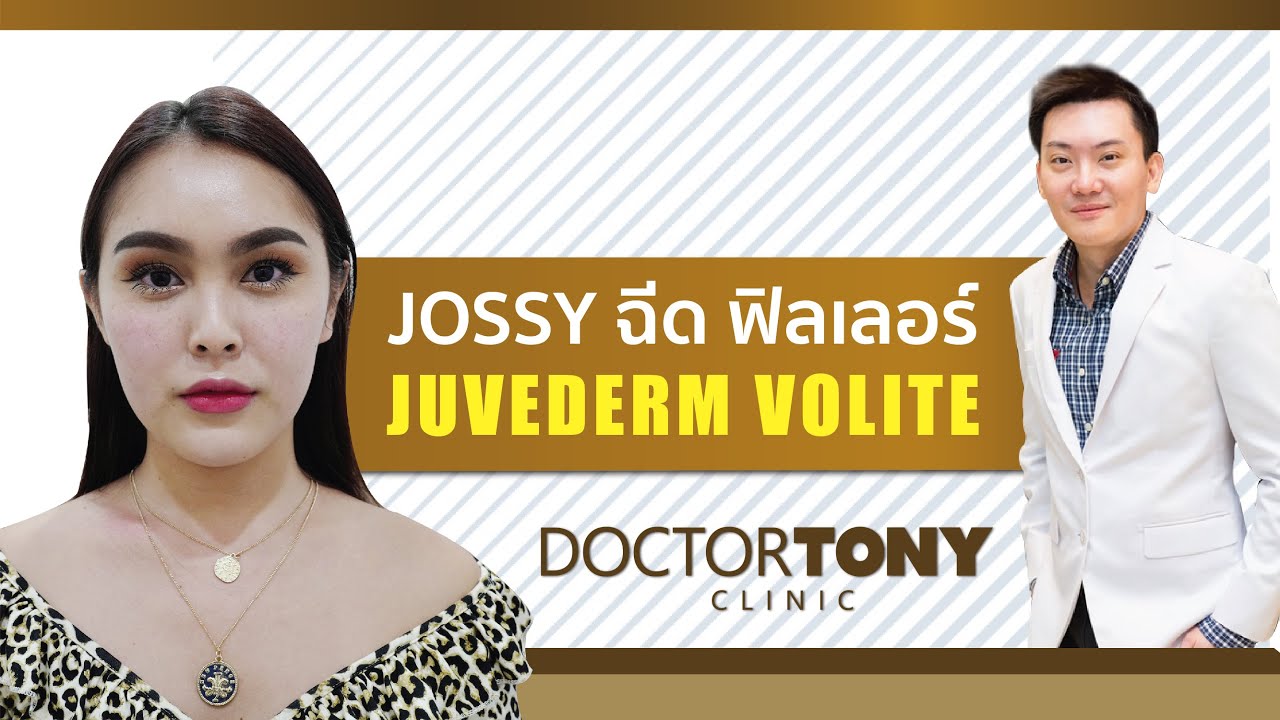 Botox and Filler : JOSSY BERRY กับ ฟิลเลอร์ JUVEDERM VOLITE by ...