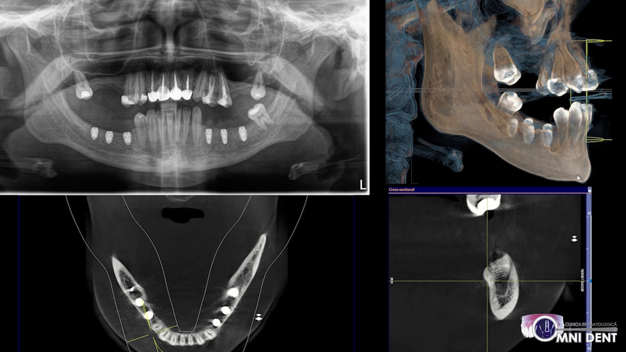 Rehabilitation of patient with severe atrophy in posterior region of ...