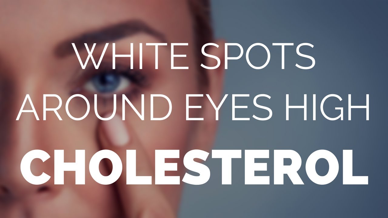White Spots Around Eyes High Cholesterol Will I Get Xanthelasma YouTube white-spots-around-eyes-high-cholesterol-will-i-get-xanthelasma-youtube
