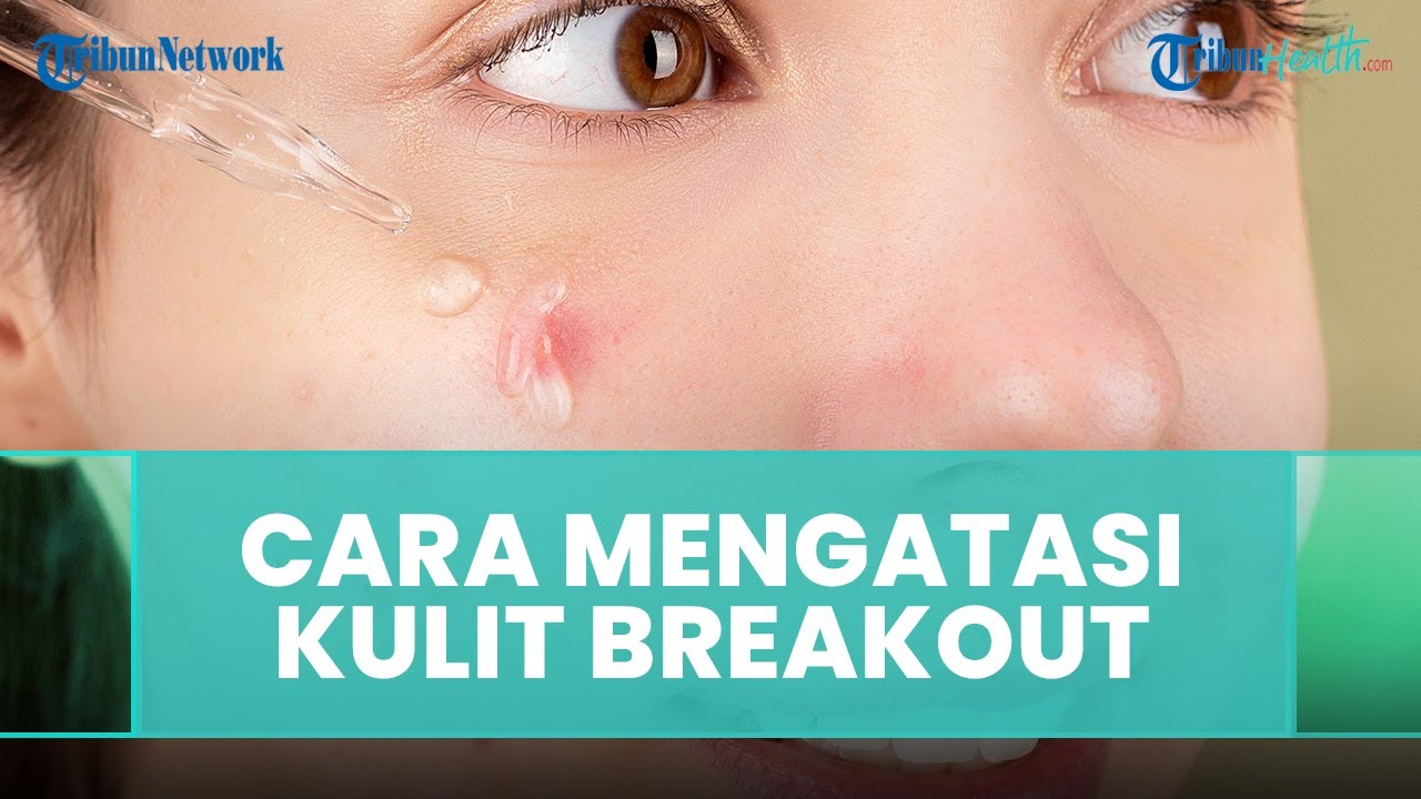 Penyebab dan Cara Mengatasi Kulit yang Sedang Breakout - YouTube