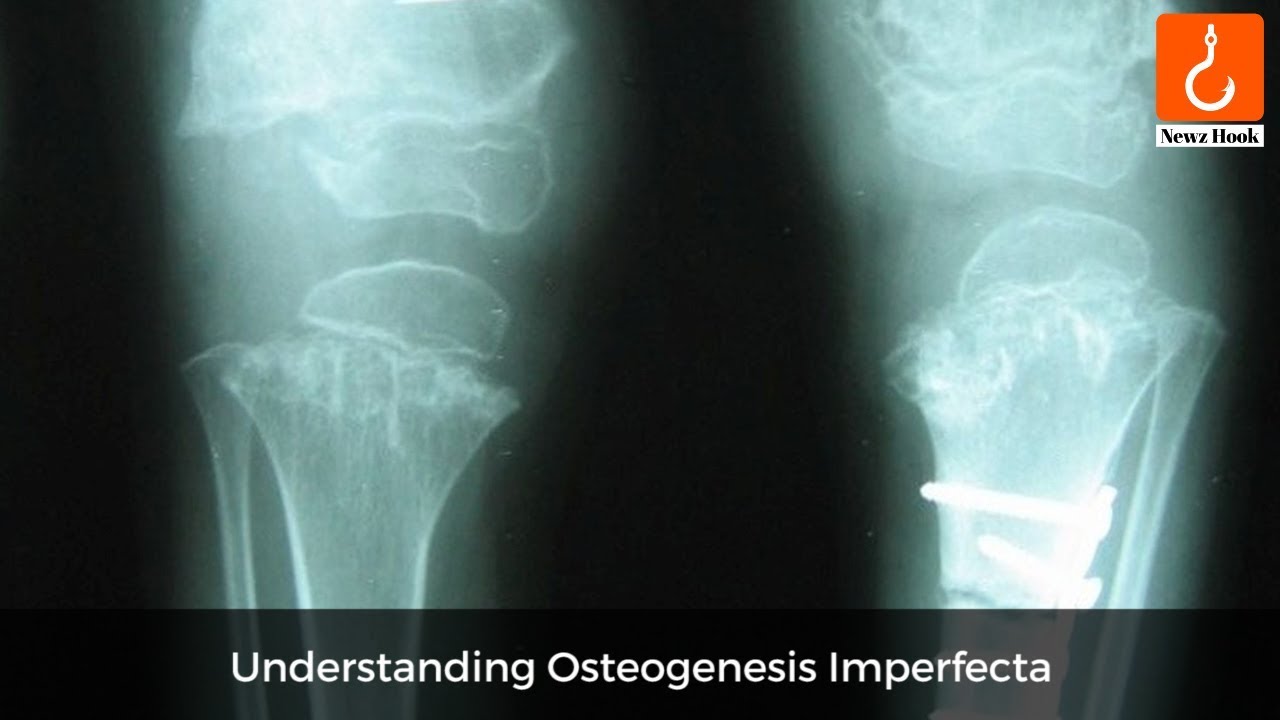 Understanding Osteogenesis Imperfecta - YouTube