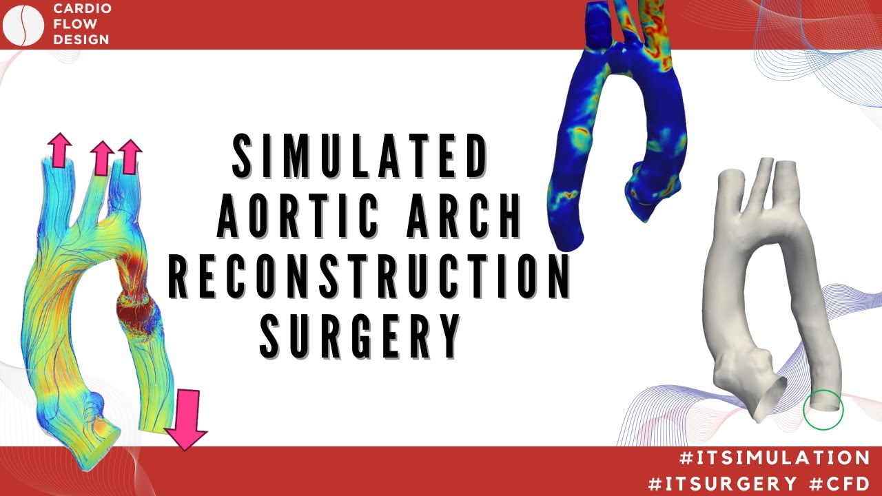iTSimulation: Coarctation Aortic Arch Reconstruction Pre/Post "Virtual ...