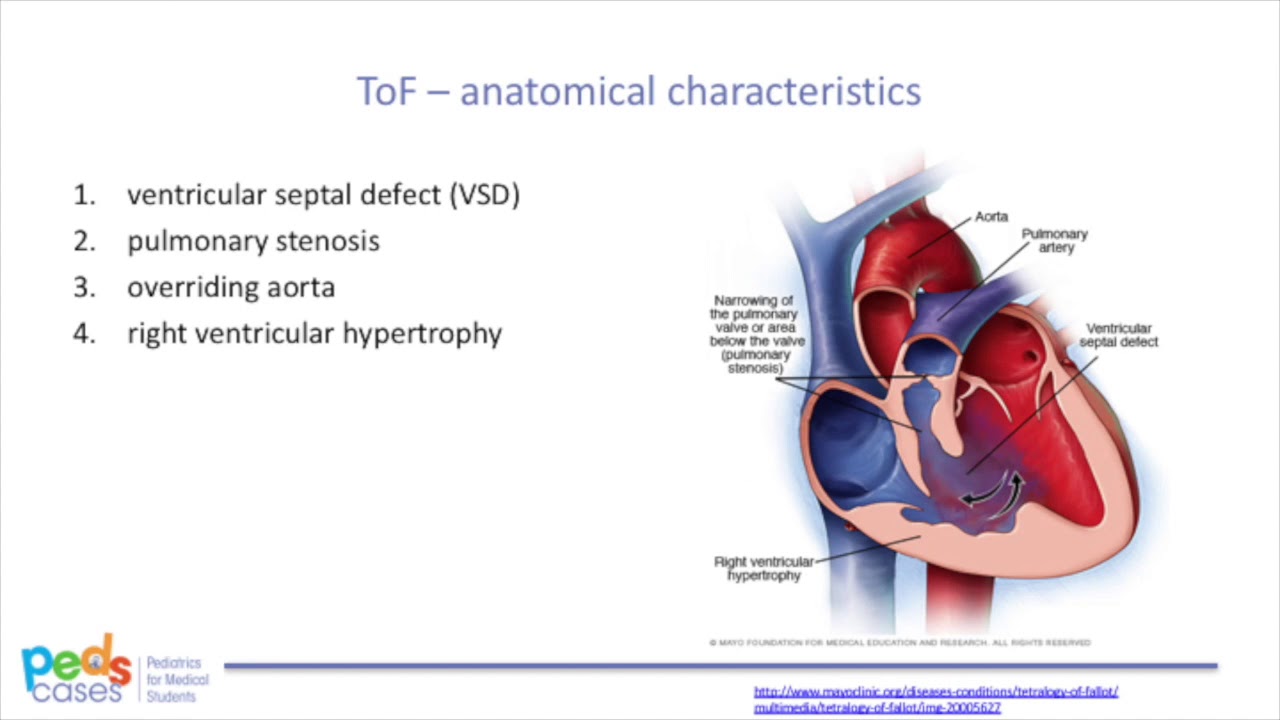 Tetralogy of Fallot - YouTube