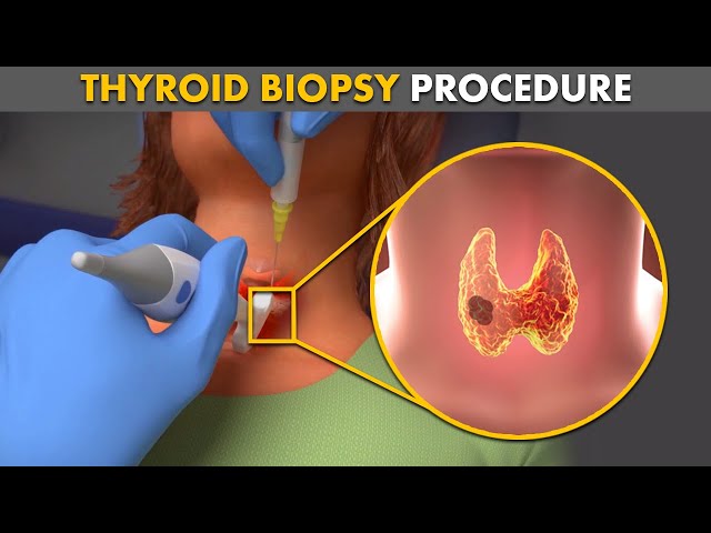 Thyroid Nodules Biopsy Beyond The Biopsy: Revolutionizing Thyroid