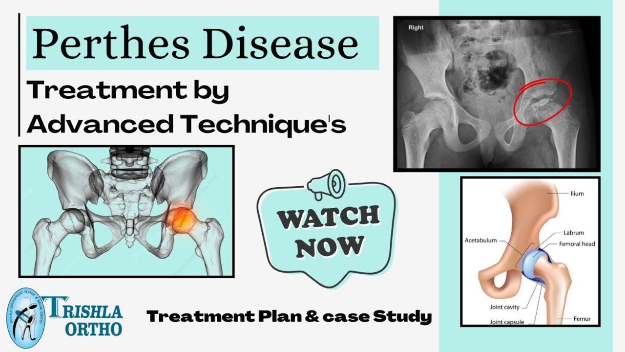 Perthes Disease Orthopedics in Hindi: Treatment Plan & Case ...