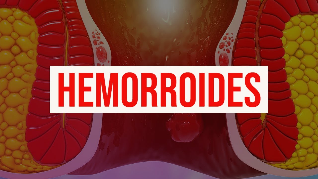 Hemorroides: causas, diagnóstico, síntomas, tratamiento y prevención ...