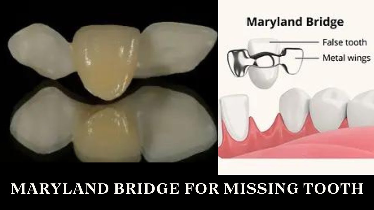 A Simpler, Cheaper Tooth Replacement? Discover the Maryland Bridge ...