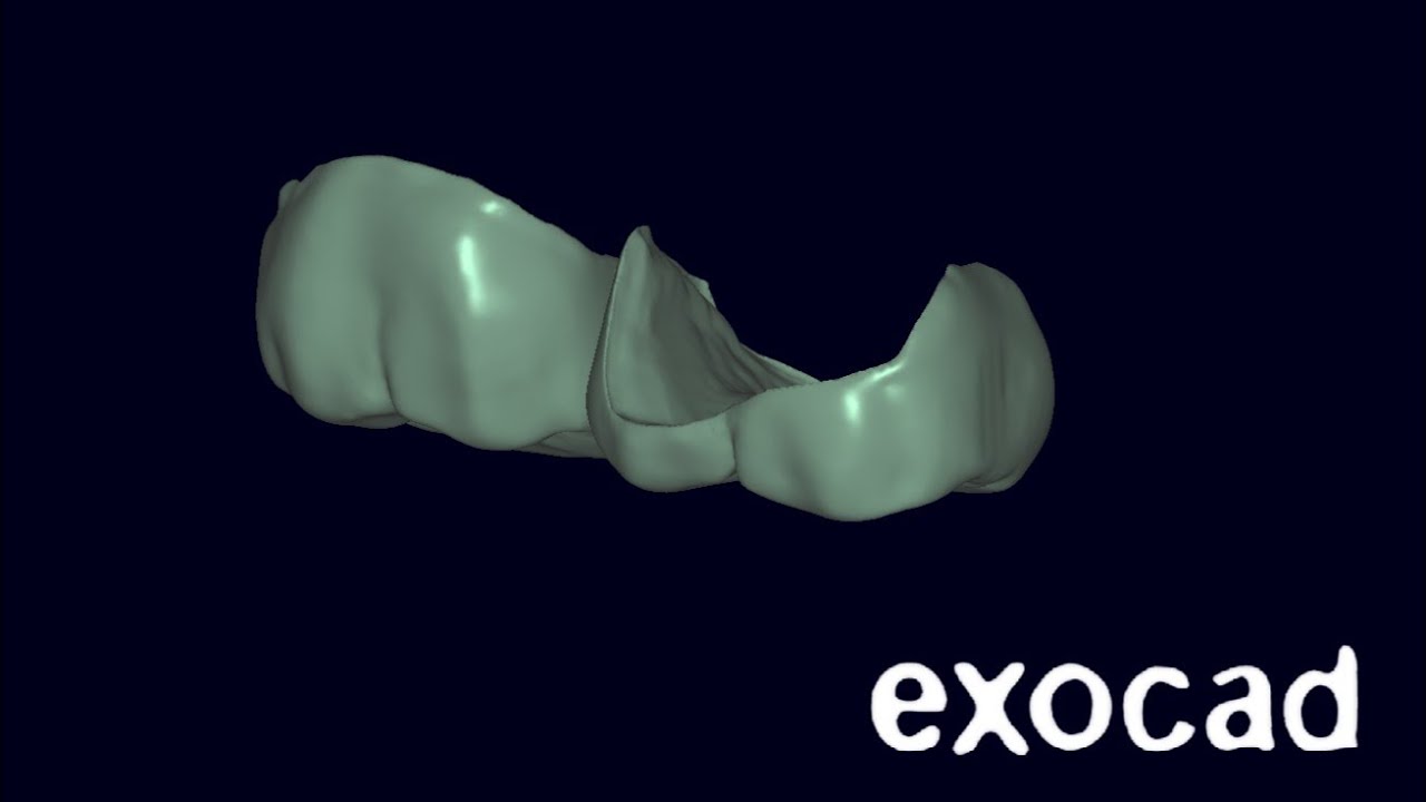 Exocad Overlay Design | Maxillary Right First and Second Molar Design ...