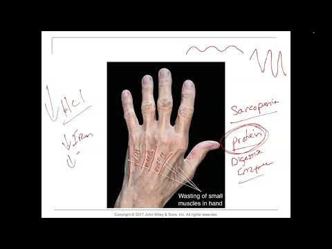 Muscle Atrophy vs Hypertrophy, Sarcopenia, Protein and Stomach Acid ...