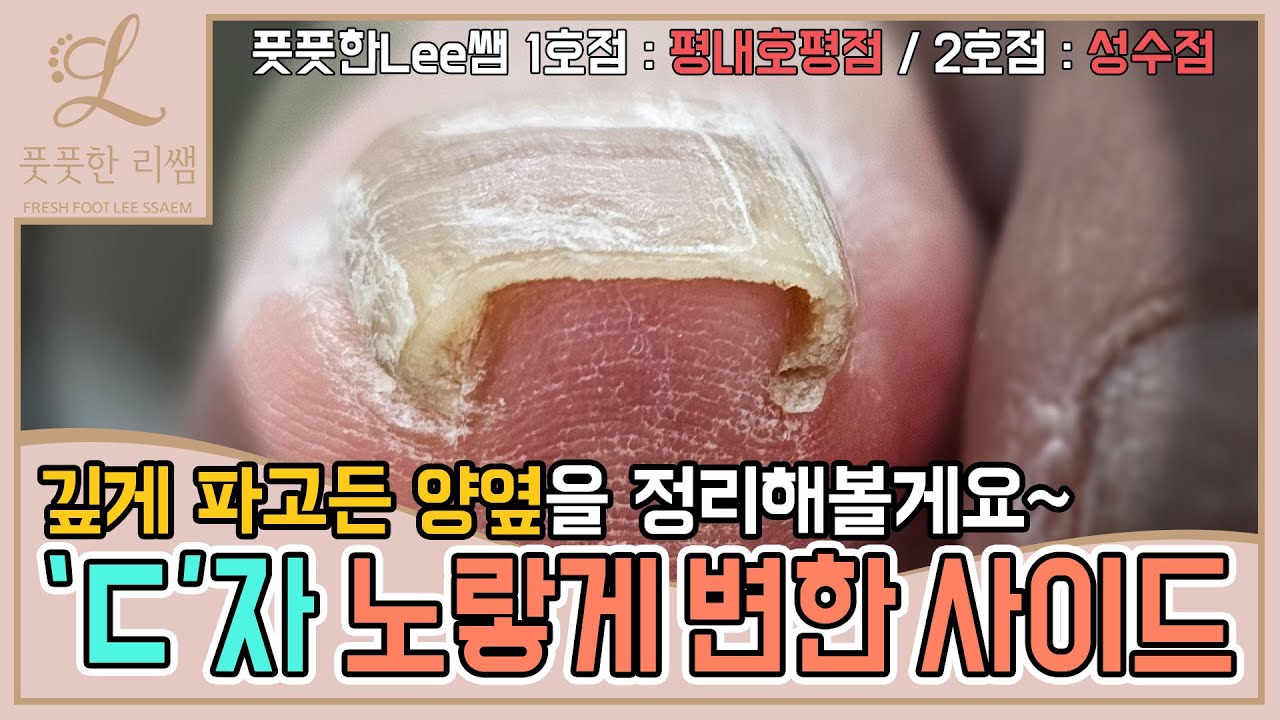 남편께서 추천! ㄷ자로 노랗게 변한 사이드 발톱 ingrown toenail / tinea unguium - Fresh Foot ...