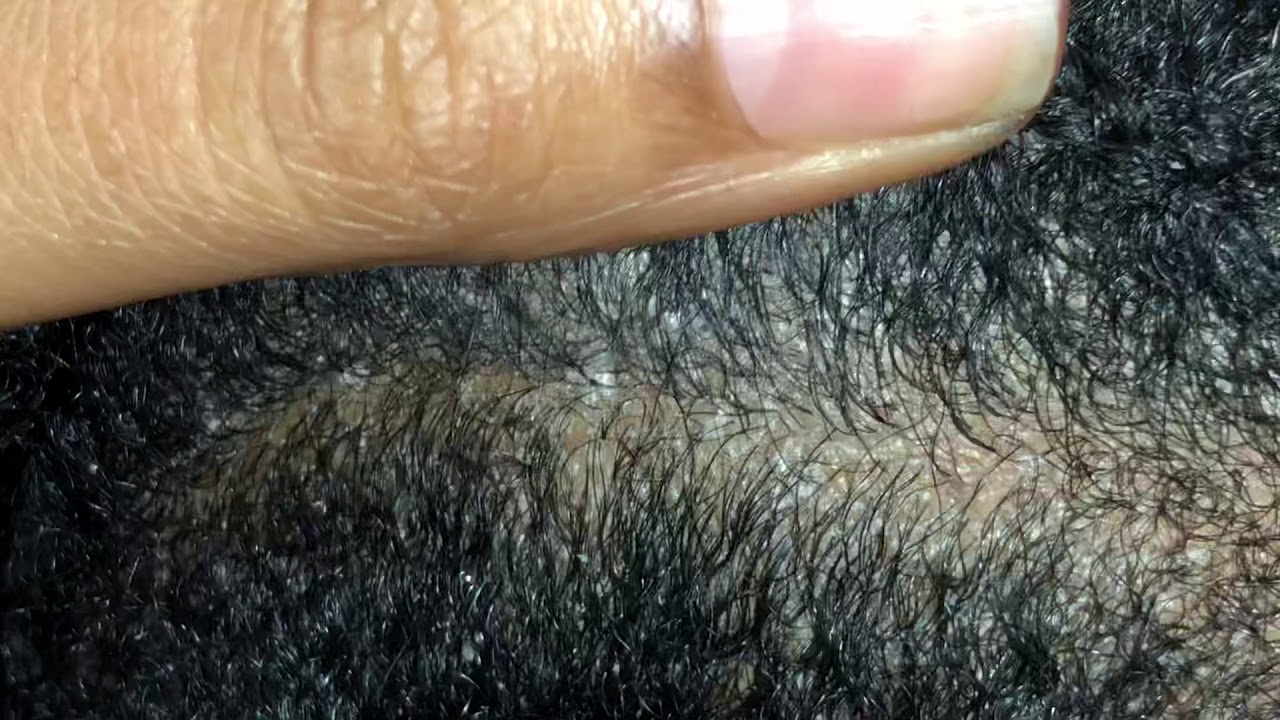 Dandruff Wars: Scalp Before Dandruff Scraping - YouTube