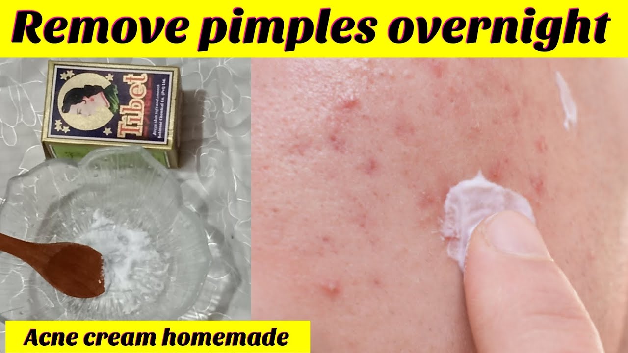 How to remove pimples overnight|Acne treatment|homemade cream|born to ...