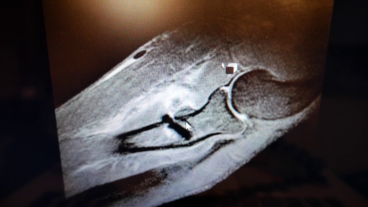 VLog Year 1.5: Recovery Following Distal Bicep Tendon Rupture ...