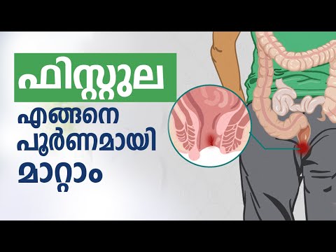 ഫിസ്റ്റുല എങ്ങനെ പൂർണമായി മാറ്റാം | What is Fistula | Best Treatment for Anal Fistula