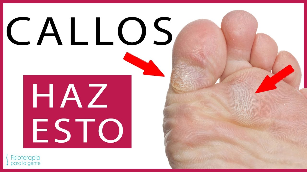 Callos en los pies, Realiza esto O TE SEGUIRÁN SALIENDO 🙄 - YouTube