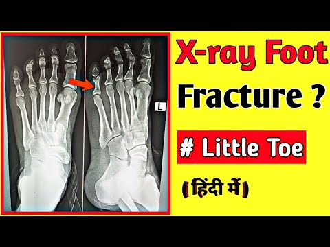 How to read Foot Fracture X-Ray | Fracture little Toe | Fracture ...