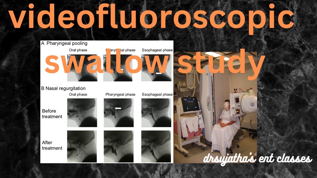 218.Videofluoroscopic Swallow Study #VFS #dysphagia #investigation ...