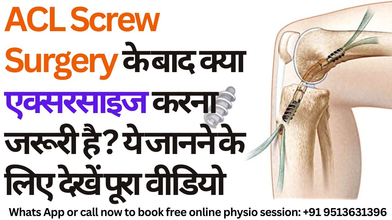 ACL Screw Surgery के बाद क्या एक्सरसाइज करना जरूरी है ? ये जानने के लिए ...