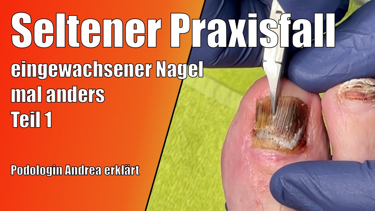 Seltener Praxisfall, eingewachsenem Nagel, Teil 1 Podologin Andrea ...