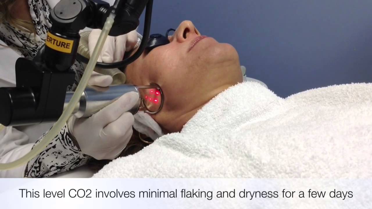 CO2 Laser Resurfacing - YouTube