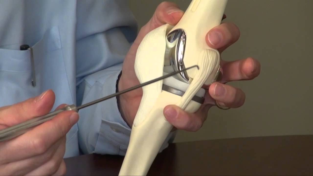 Knee Arthritis - Advanced Bone & Joint - Dr. Dane Glueck - YouTube