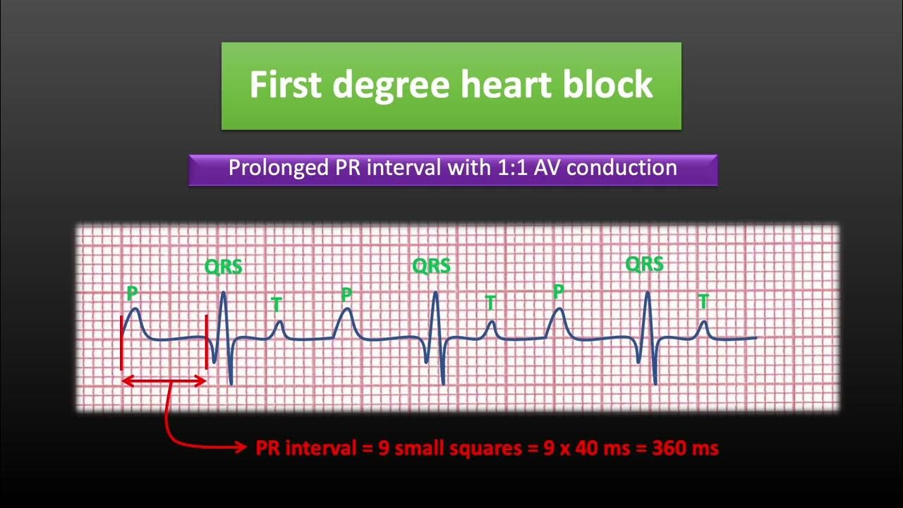 How To Identify Heart Blocks On Ecg Av Blocks On Ecg Learningcardiology Youtube