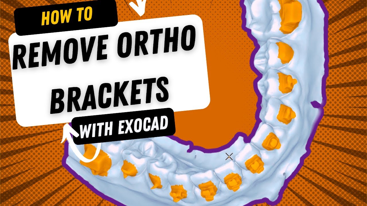 Removing Ortho Brackets Using Exocad - YouTube