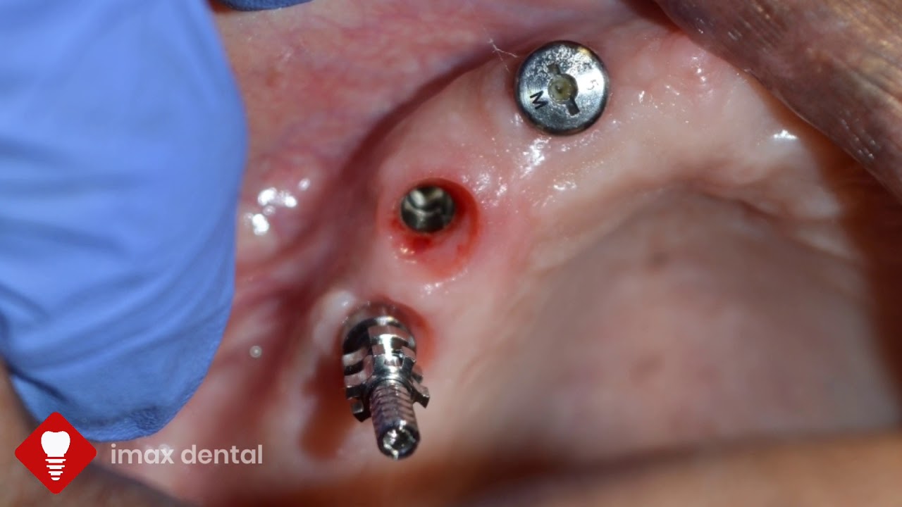 Imax Dental Clinic Deesa full mouth implant supported fixed teeth case ...