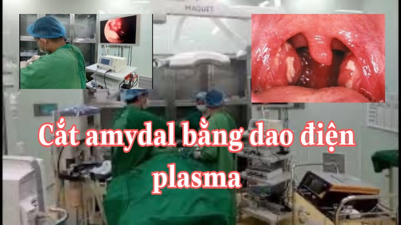Kỹ thuật cắt đốt Amydal bằng dao plasma - YouTube