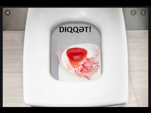 Anal Çat Necə Müalicə Olunur? - BAXIN!