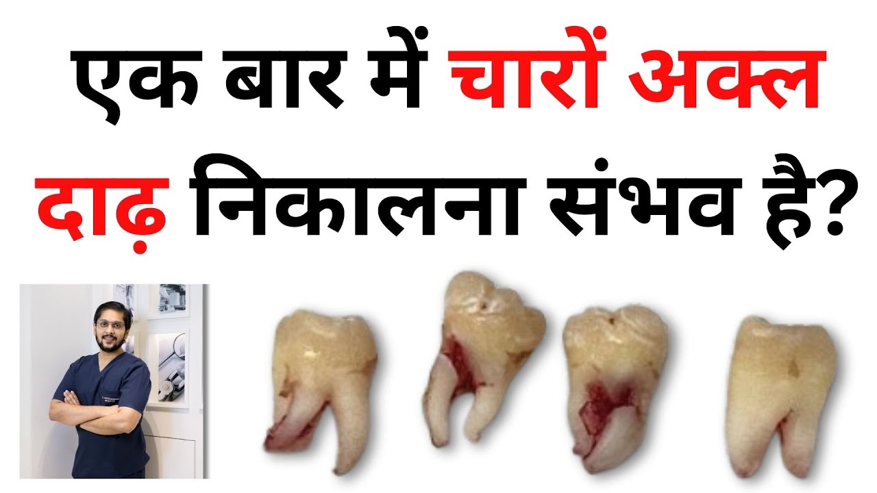 क्या चारों अक्कल दाढ़ एकसाथ निकाली जा सकती है? Wisdom tooth surgery ...
