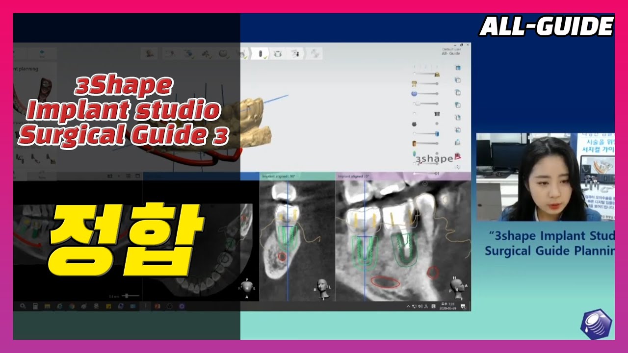 3Shape Implant studio Surgical Guide 3 - 정합 - YouTube
