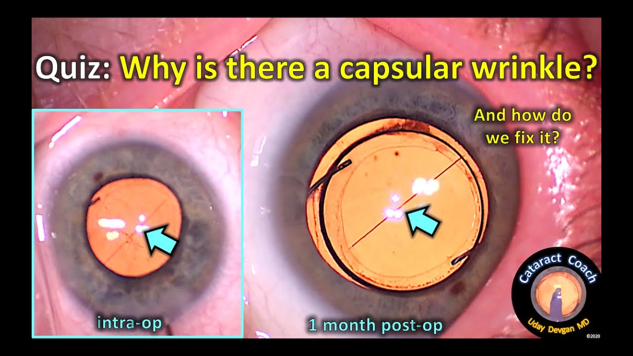 Cataract Quiz: Why is there a capsular wrinkle? - YouTube