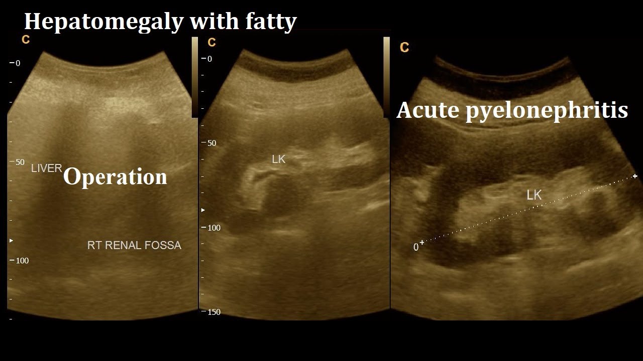 Acute pyelonephritis ultrasound | ultrasound findings | Ultrasonography ...
