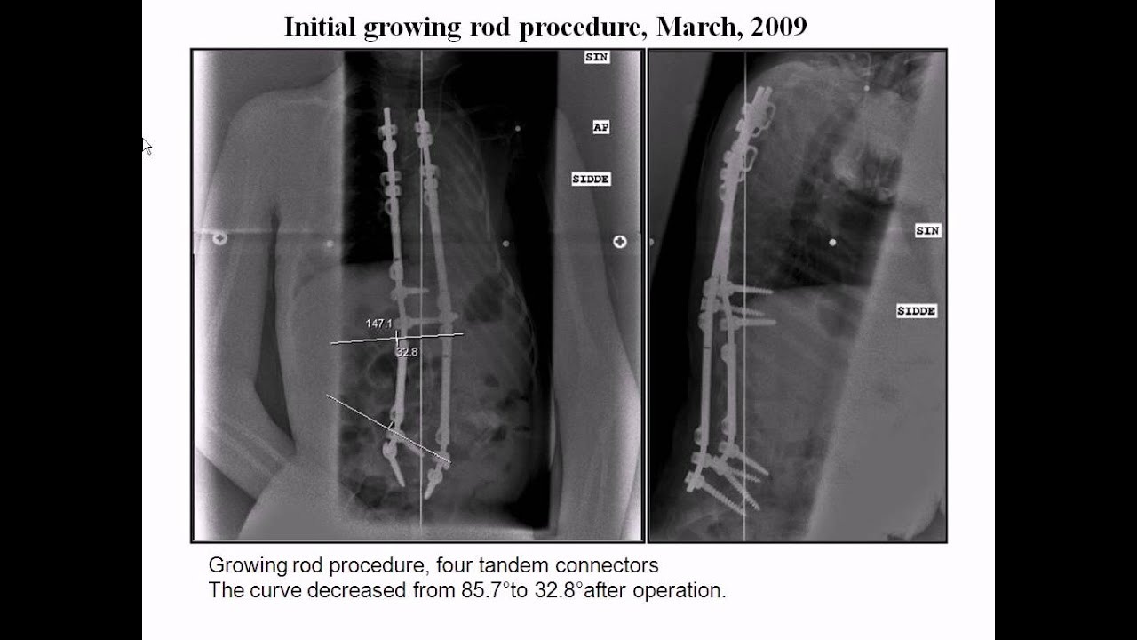 Growing Rod Surgery: Complications and how to avoid them - YouTube
