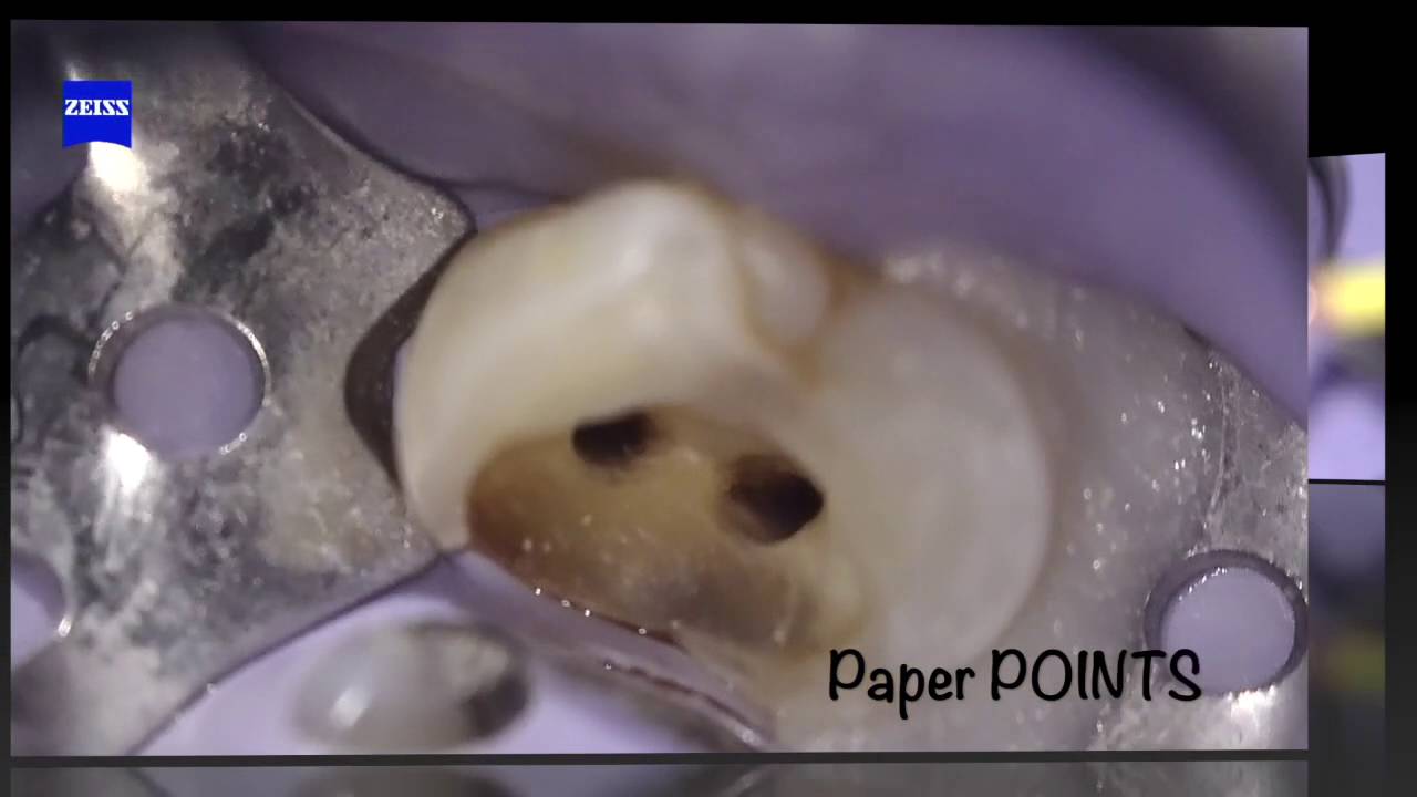 Root canal treatment under a microscope - YouTube