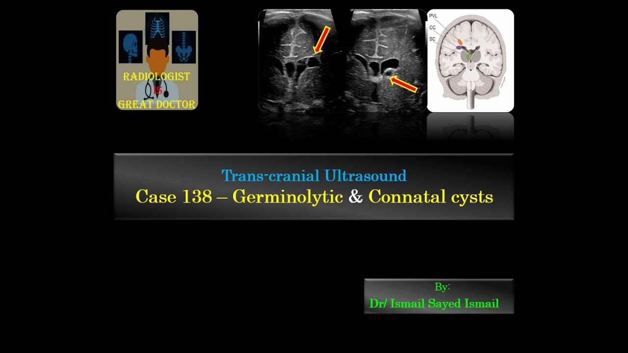 Ultrasound Case 138 - Germinolytic & Connatal Cysts - YouTube