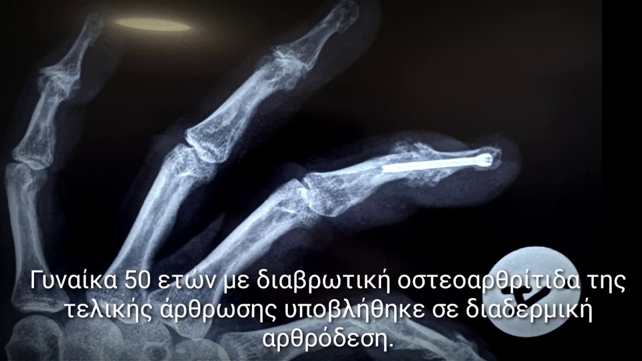 Αρθρόδεση Άπω Φαλαγγοφαλαγγικής Άρθρωσης Μέσου Δακτύλου για ...