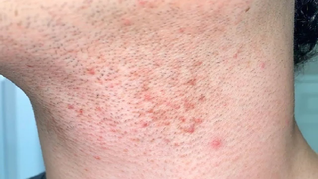 how to get rid of razor bumps on your neck naturally - YouTube