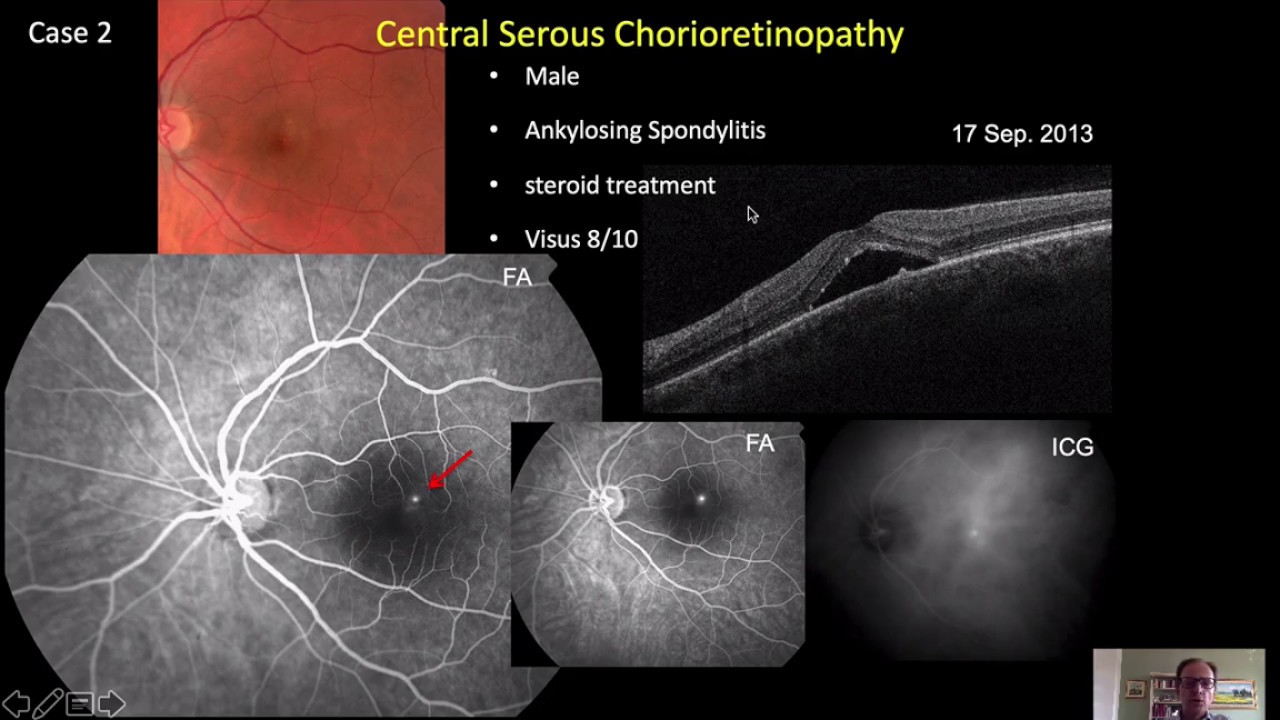 Clinical Case on Central Serous Chorioretinopathy - Massimo Nicolò ...