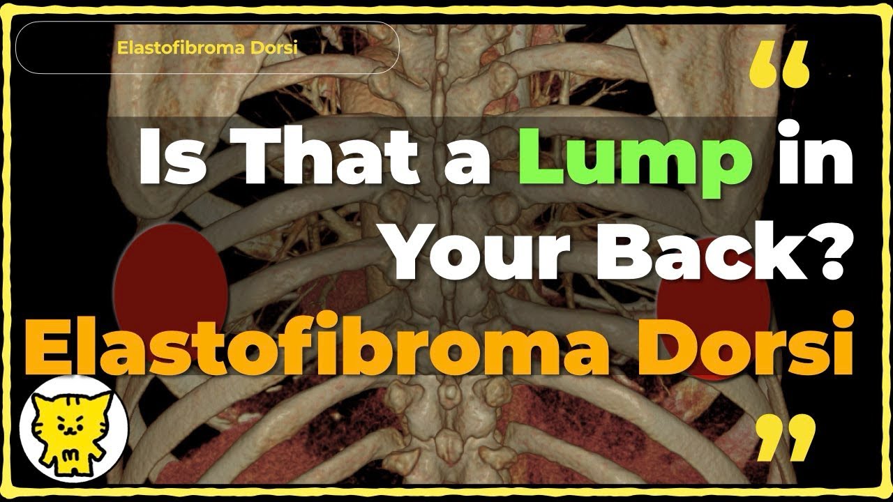 Is That a Lump in Your Back? Understanding Elastofibroma Dorsi! - YouTube