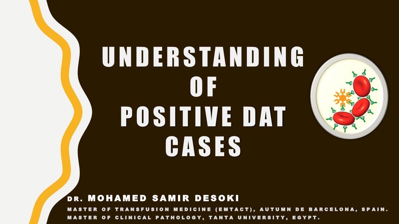 Understanding of Positive DAT Cases - Part 1. by Dr Mohamed Samir - YouTube